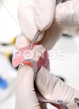 Completion of the missing teeth Partial dentures, dental and ...