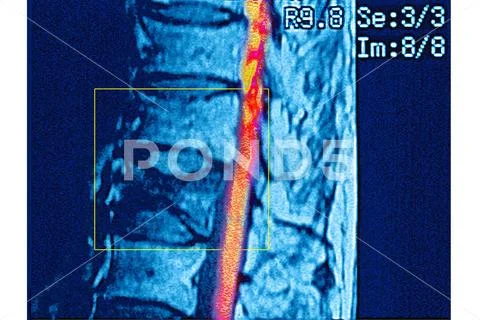 Compression fracture, mri Compression of dorsal vertebrae 11 and 12 ...