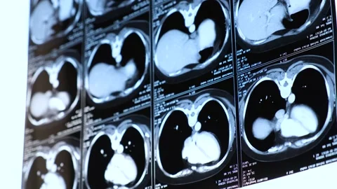 Computed tomography (CT scan) of chest w... | Stock Video | Pond5