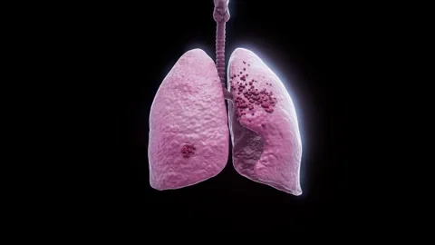 Conceptual animation of a lung cancer | Stock Video | Pond5