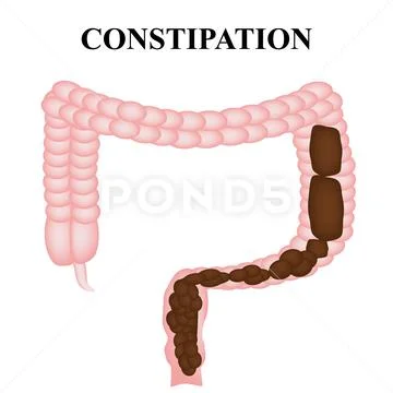Constipation. Feces in colon. Infographics. Vector illustration on ...