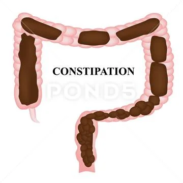 Constipation. Feces in colon. Infographics. Vector illustration on ...