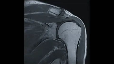 Shoulder Ligaments Stock Footage ~ Royalty Free Stock Videos | Pond5
