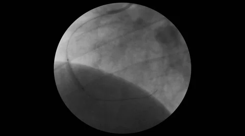 Coronary Angiogram Stock Footage ~ Royalty Free Stock Videos | Pond5