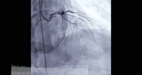 Coronary angiogram in cardiac catheteriz... | Stock Video | Pond5