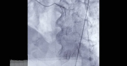 Coronary angiogram in cardiac catheteriz... | Stock Video | Pond5