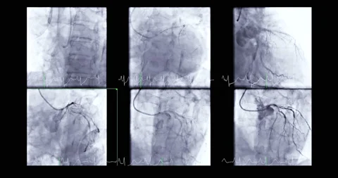 Coronary angiogram in cardiac catheteriz... | Stock Video | Pond5