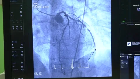 Coronary angiogram, medical x-ray for he... | Stock Video | Pond5