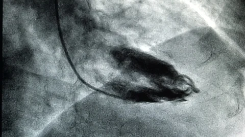 Coronary artery angiogram of left corona... | Stock Video | Pond5