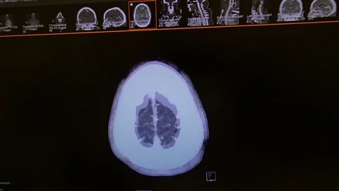 CT Brain angiography - transverse image ... | Stock Video | Pond5