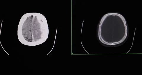 A CT brain scan of a patient with subdur... | Stock Video | Pond5