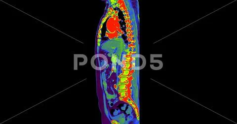 CT Chest and Abdomen with injection contrast media sagittal plane for ...