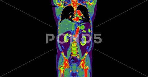 CT Chest and Abdomen with injection contrast media coronal view for ...
