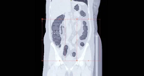 CT colonography or CT Scan of large inte... | Stock Video | Pond5