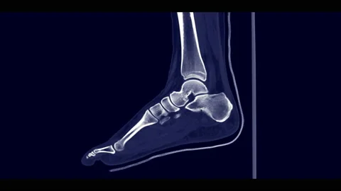 ct foot sag | Stock Video | Pond5