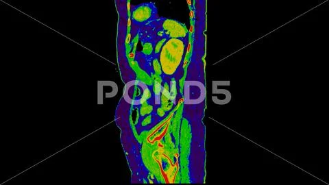 CT scan of Abdomen sagittal view with injection contrast media with ...