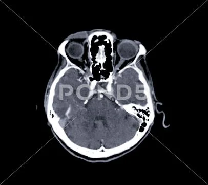 CT scan of the brain Axial plane for diagnosis brain tumor,stroke ...