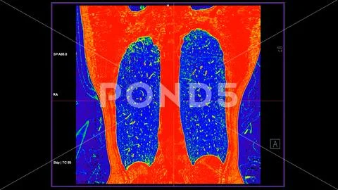 CT scan of Chest coronal view in color mode for diagnostic Pulmonary ...