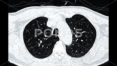 CT scan of Chest or lung axial view for screening lung nodules and lung ...