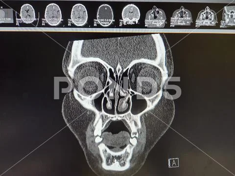 Face Ct Scan – Facial X Ray Vs Ct – KLTG