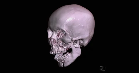 CT Scan of facial bone 3D. | Stock Video | Pond5