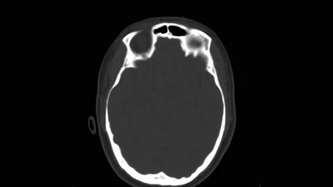 CT scan head & neck showing skull base f... | Stock Video | Pond5