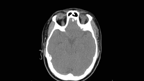 CT scan head & neck showing skull base f... | Stock Video | Pond5