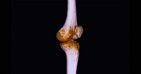 CT Scan of knee joint 3d rendering. | Stock Video | Pond5