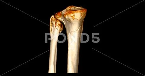 CT Scan of Knee joint showing fracture tibia and fibula bone 3D ...