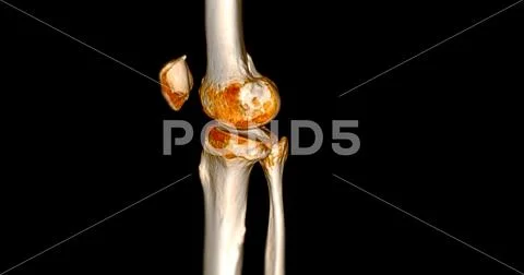 Photograph: CT Scan of Knee joint showing fracture tibia and fibula ...