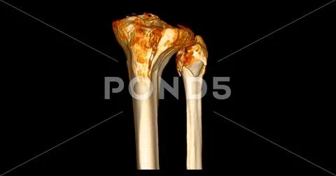 CT Scan of Knee joint showing fracture tibia and fibula bone 3D ...