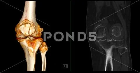 CT Scan of Knee joint showing fracture tibia and fibula bone 3D ...