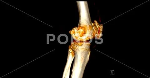 CT Scan of Knee joint showing fracture tibia and fibula bone 3D ...