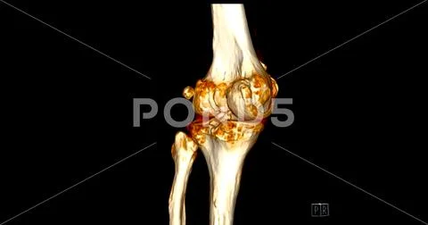 CT Scan of Knee joint showing fracture tibia and fibula bone 3D ...