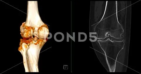 CT Scan of Knee joint showing fracture tibia and fibula bone 3D ...