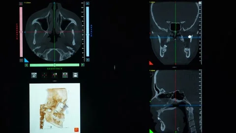 CT scan of a patient with malocclusion, ... | Stock Video | Pond5