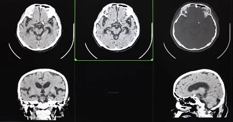 CT scan of a patient with severe brain a... | Stock Video | Pond5