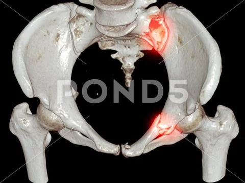 CT Scan pelvic bone with both hip joint 3D rendering showign fracture ...