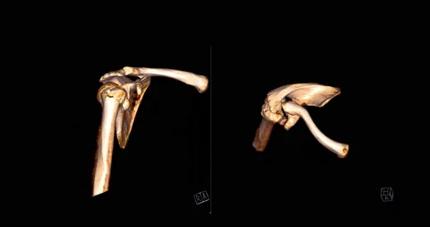 CT scan Shoulder joint 3D. | Stock Video | Pond5