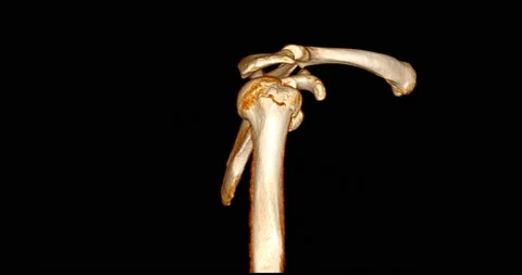 CT scan Shoulder joint 3D. | Stock Video | Pond5