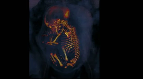 CT scan showing a full term human fetus | Stock Video | Pond5