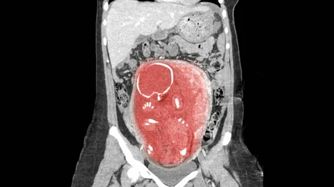 CT scan showing a full term human fetus | Stock Video | Pond5