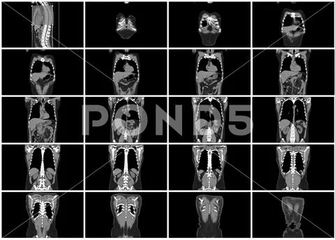 Ct scan step set of body coronal view ~ Hi Res #103555453