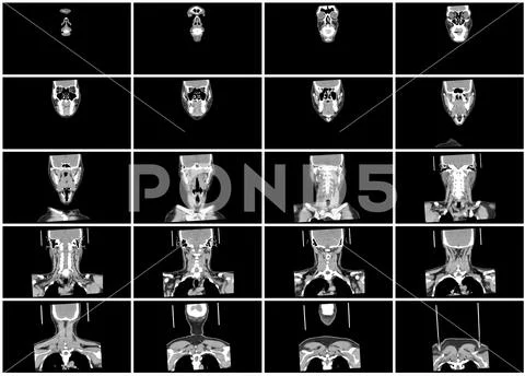 Ct scan step set of neck coronal view Stock Image #103555406
