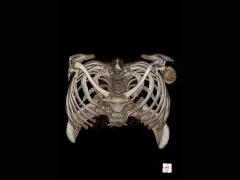 CT Scan Thoracic spine ct with 3D recons... | Stock Video | Pond5