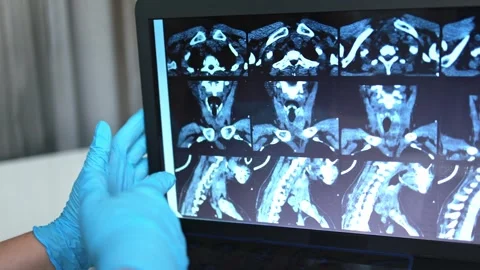 CT scan of the thyroid gland. MRI | Stock Video | Pond5