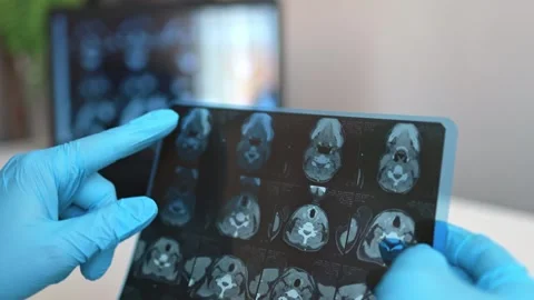 CT scan of the thyroid gland. MRI | Stock Video | Pond5