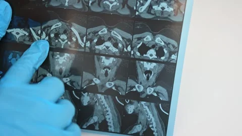 CT scan of the thyroid gland. MRI | Stock Video | Pond5