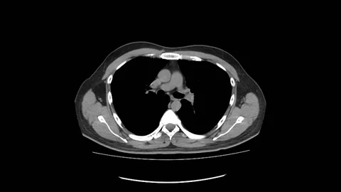 ct scan of upper abdomen top view smooth... | Stock Video | Pond5