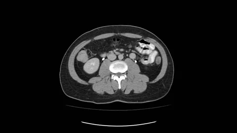 ct scan of upper abdomen top view smooth... | Stock Video | Pond5
